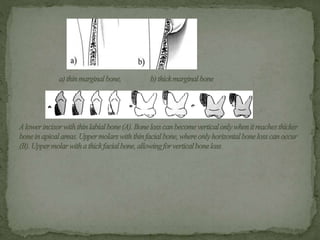 Biologic width | PPTX