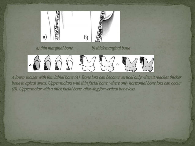 Biologic width | PPT
