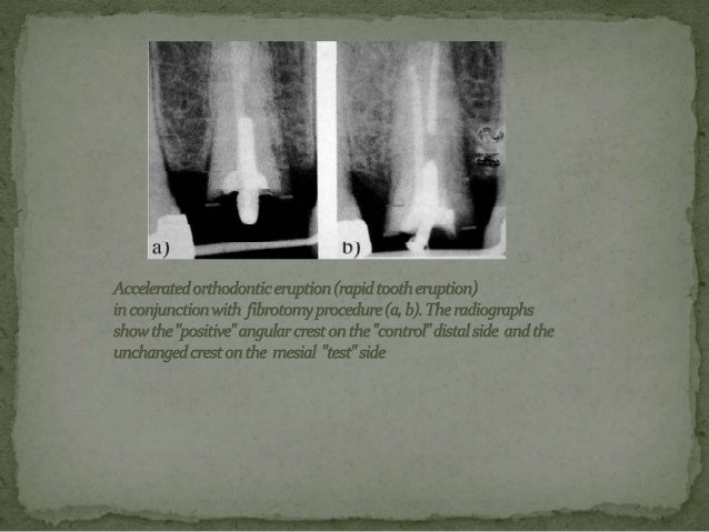 Biologic Width
