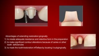Biologic width | PPTX