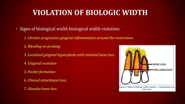 Biologic width | PPTX