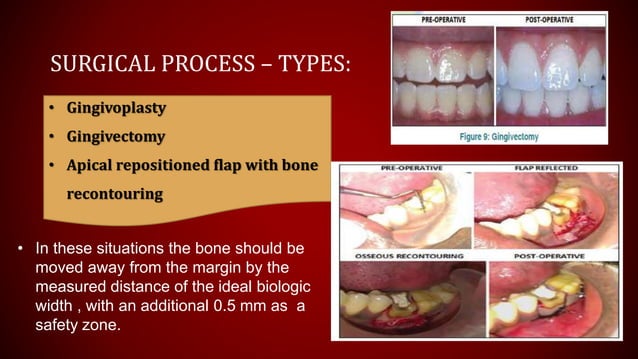 Biologic width | PPTX