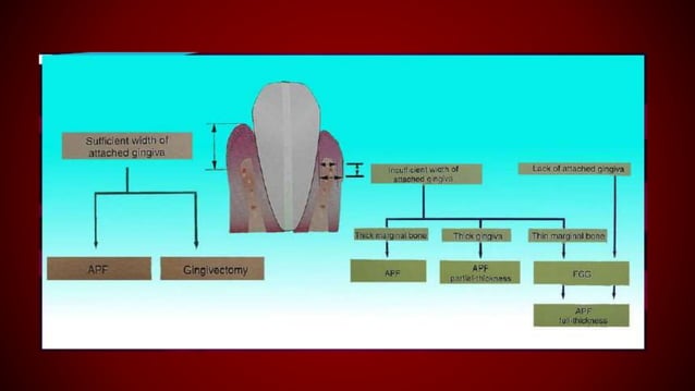 Biologic width | PPTX