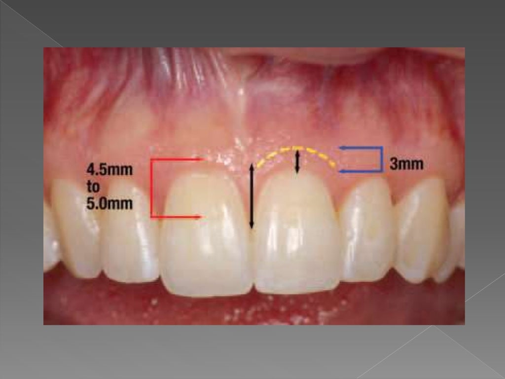 Biologic Width Importance In Periodontal And Restorative Dentistry