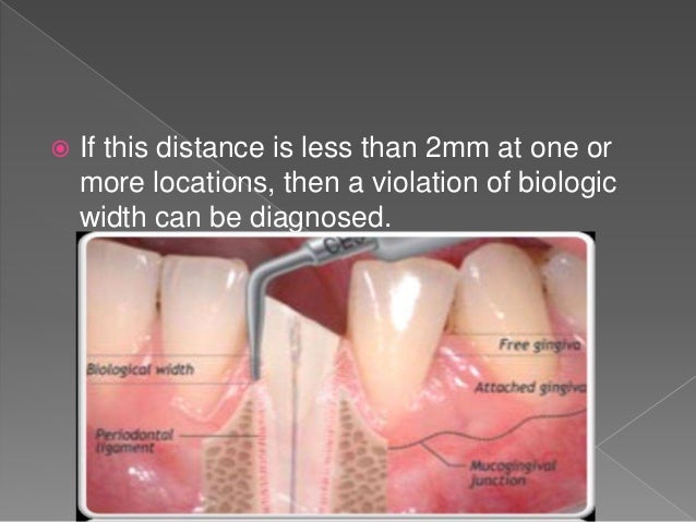 Biologic width - Importance in Periodontal and Restorative Dentistry