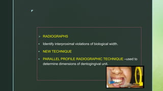 Biologic width | PPTX