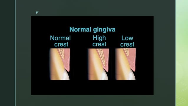 Biologic width | PPTX