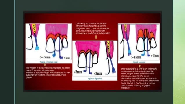 Biologic width | PPTX