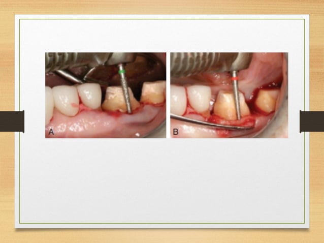 discussing periodontal prosthodontic relation | PPT