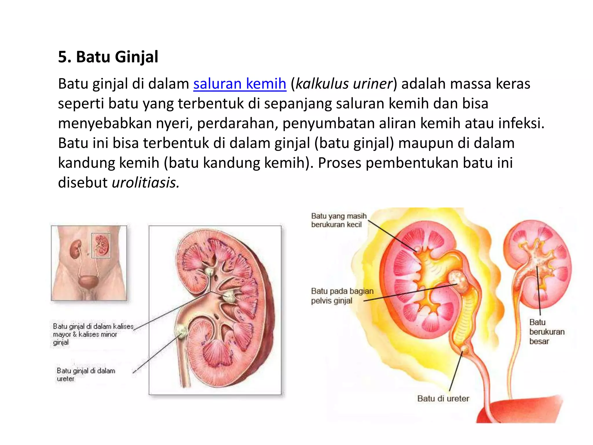 Kelainan Dan penyakit Pada Ginjal | PPTX