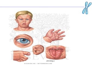 gjenet dhe semundjet gjenetike