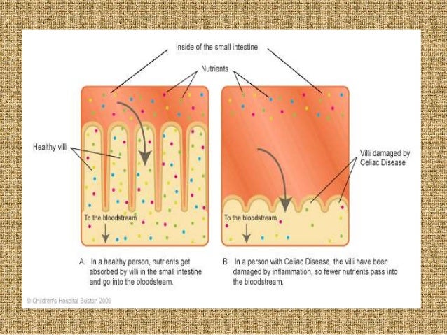 Malabsorption Syndrome