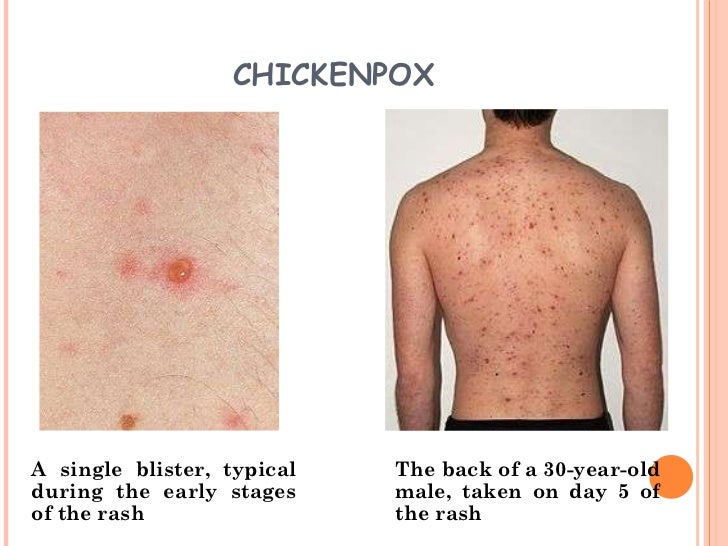 Chickenpox And Pregnancy Everything You Need To Know