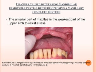 Biology of bone in complete dentures, removable partial denture ...