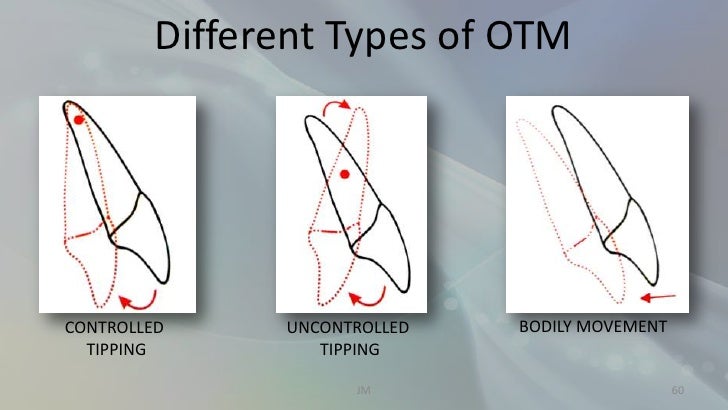 Biology of OrthodonticTooth Movement