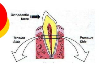 Biology of orthodontic tooth movement | PPT