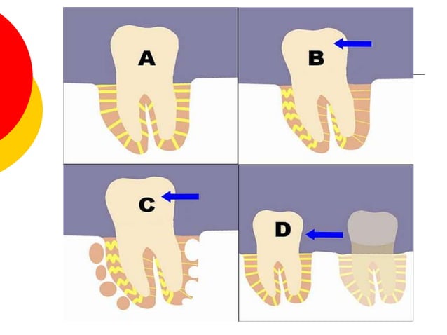 Biology of orthodontic tooth movement | PPT | Bone and Joint Conditions ...