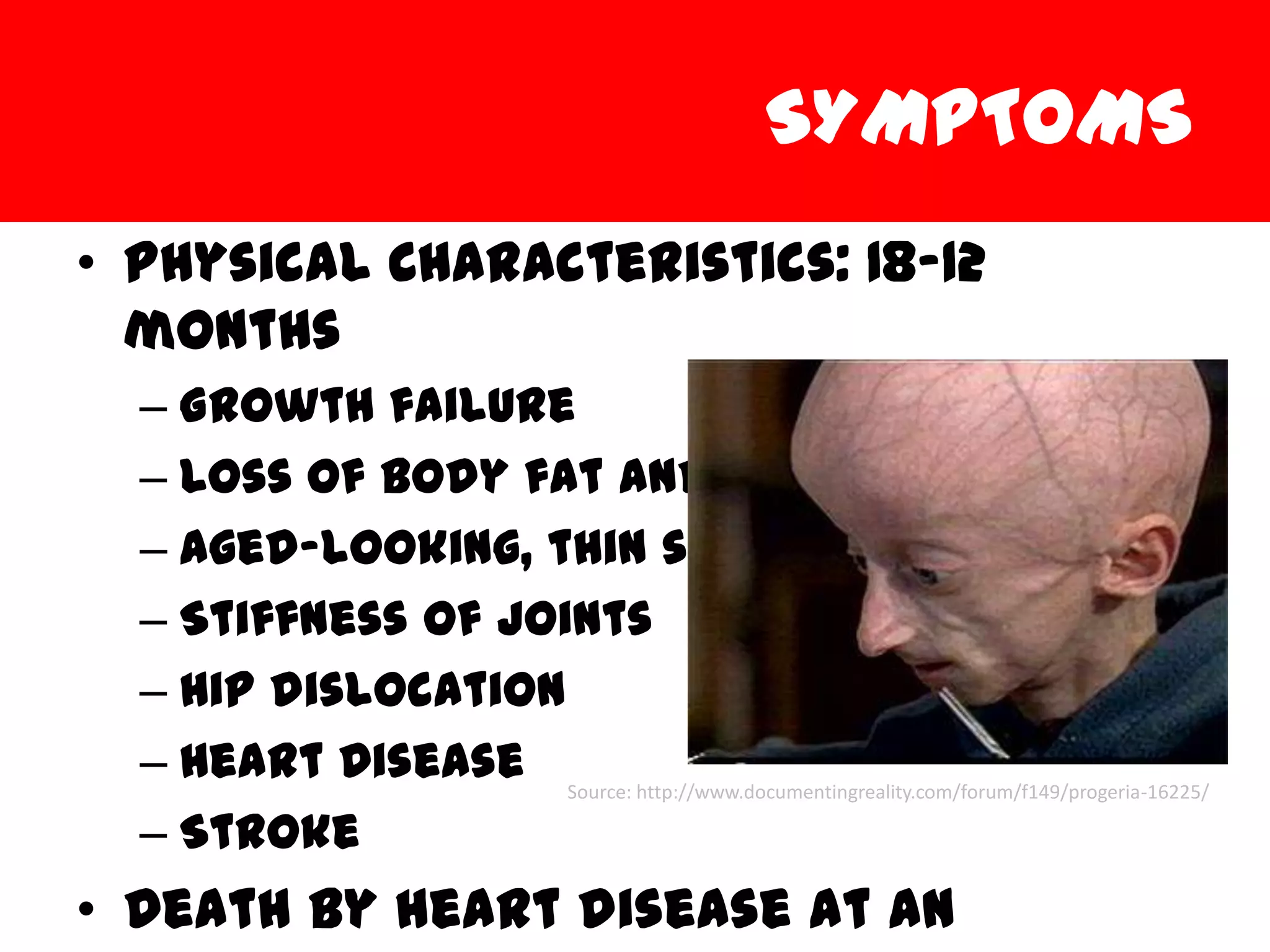Biology project progeria | PPTX