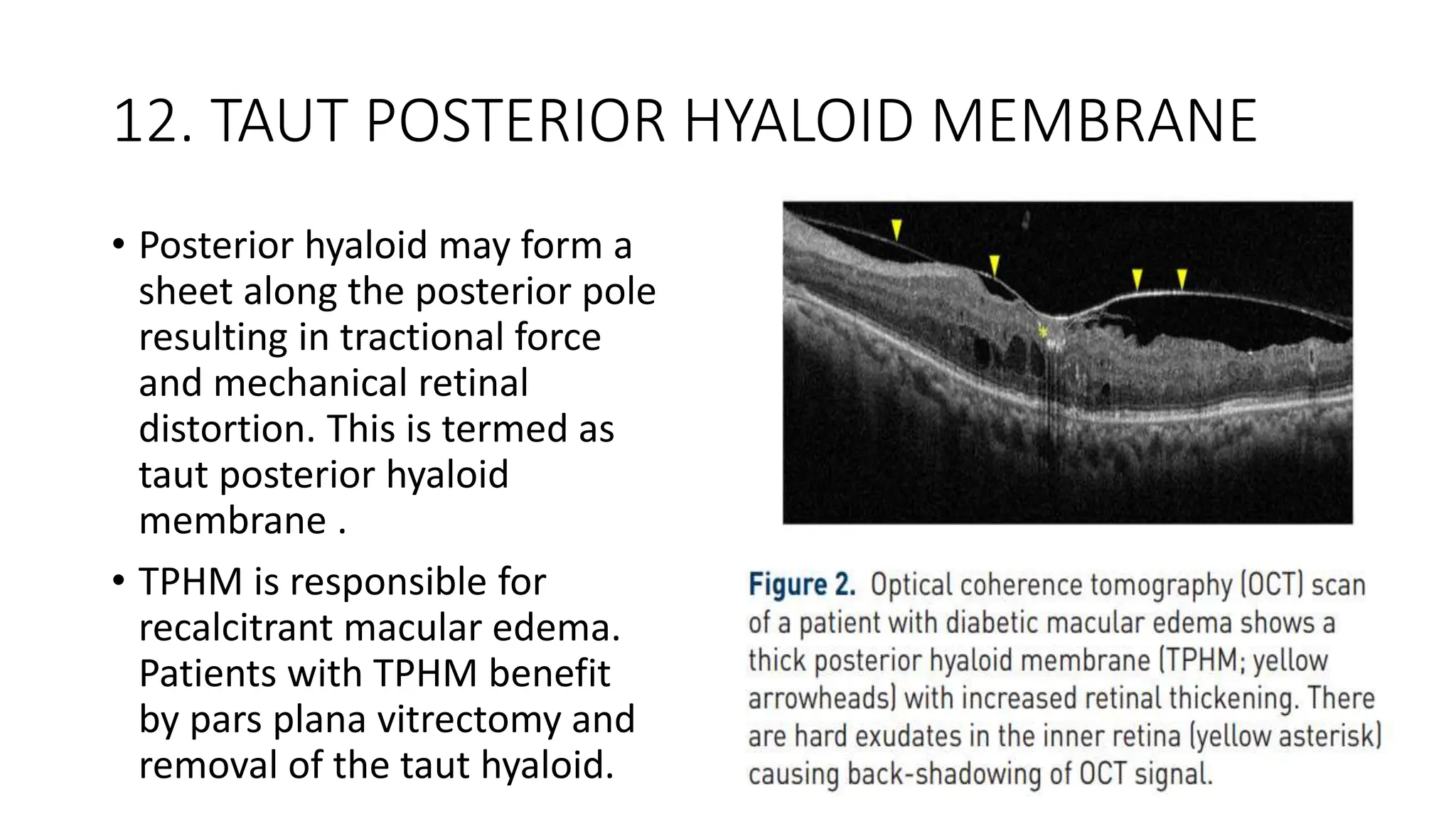 oct biomarkers in Diabetic retinop. pptx | PPTX