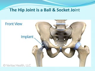 Currently favored Biomaterials in total hip replacements | PPTX