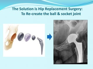 Currently favored Biomaterials in total hip replacements | PPTX