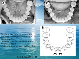Biomechancs in Orthodotnics | PPTX
