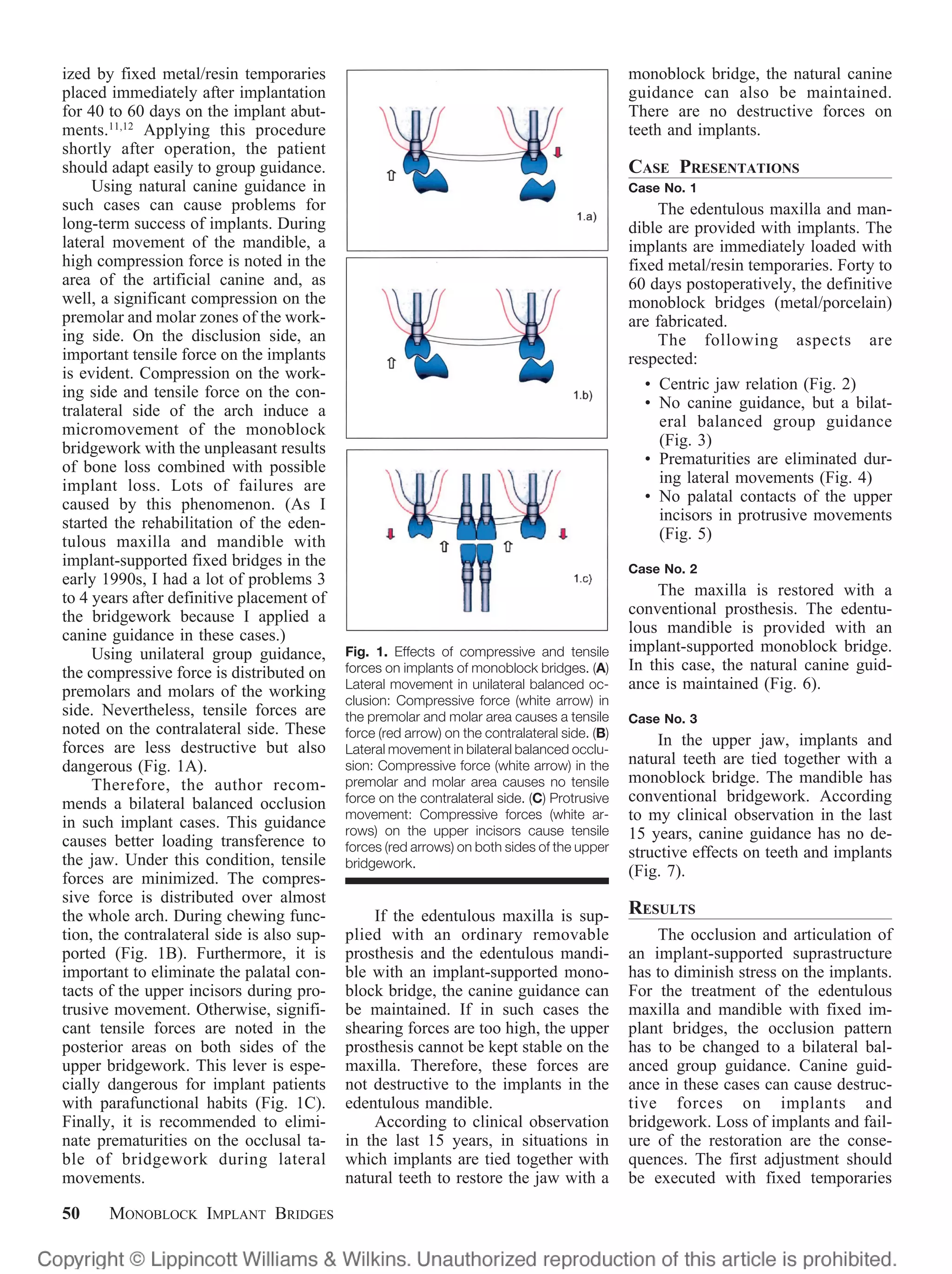 Biomechanical aspects of monoblock implant bridges for the edentulous ...