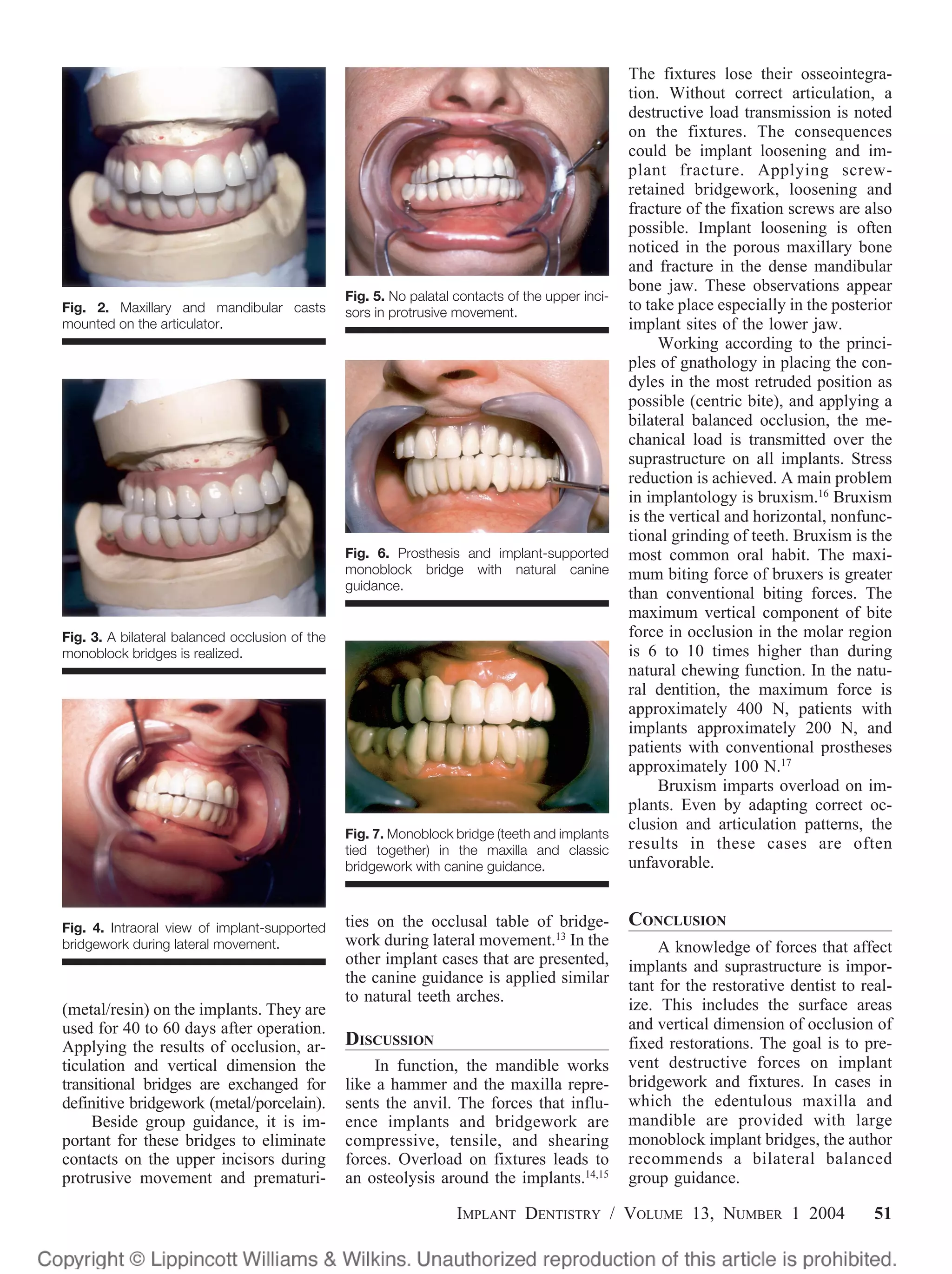 Biomechanical aspects of monoblock implant bridges for the edentulous ...