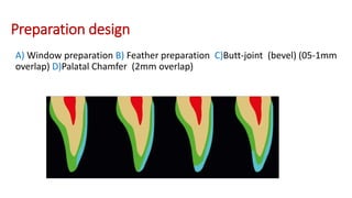biomechanical consideration in partally coverage fixed prosthodontics.pptx
