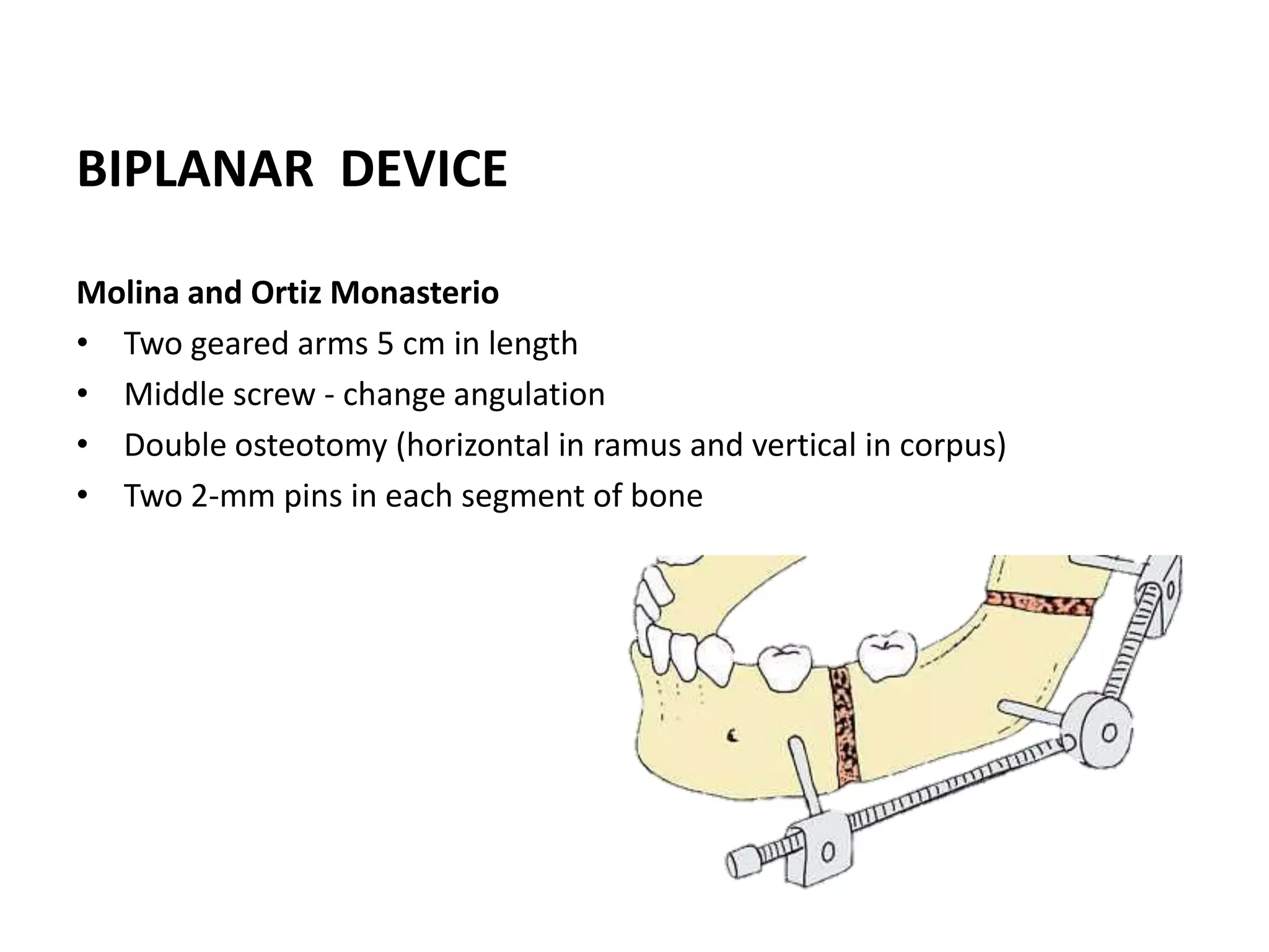 BIOMECHANICAL CONSIDERATIONS IN DISTRACTION OSTEOGENESIS.pptx