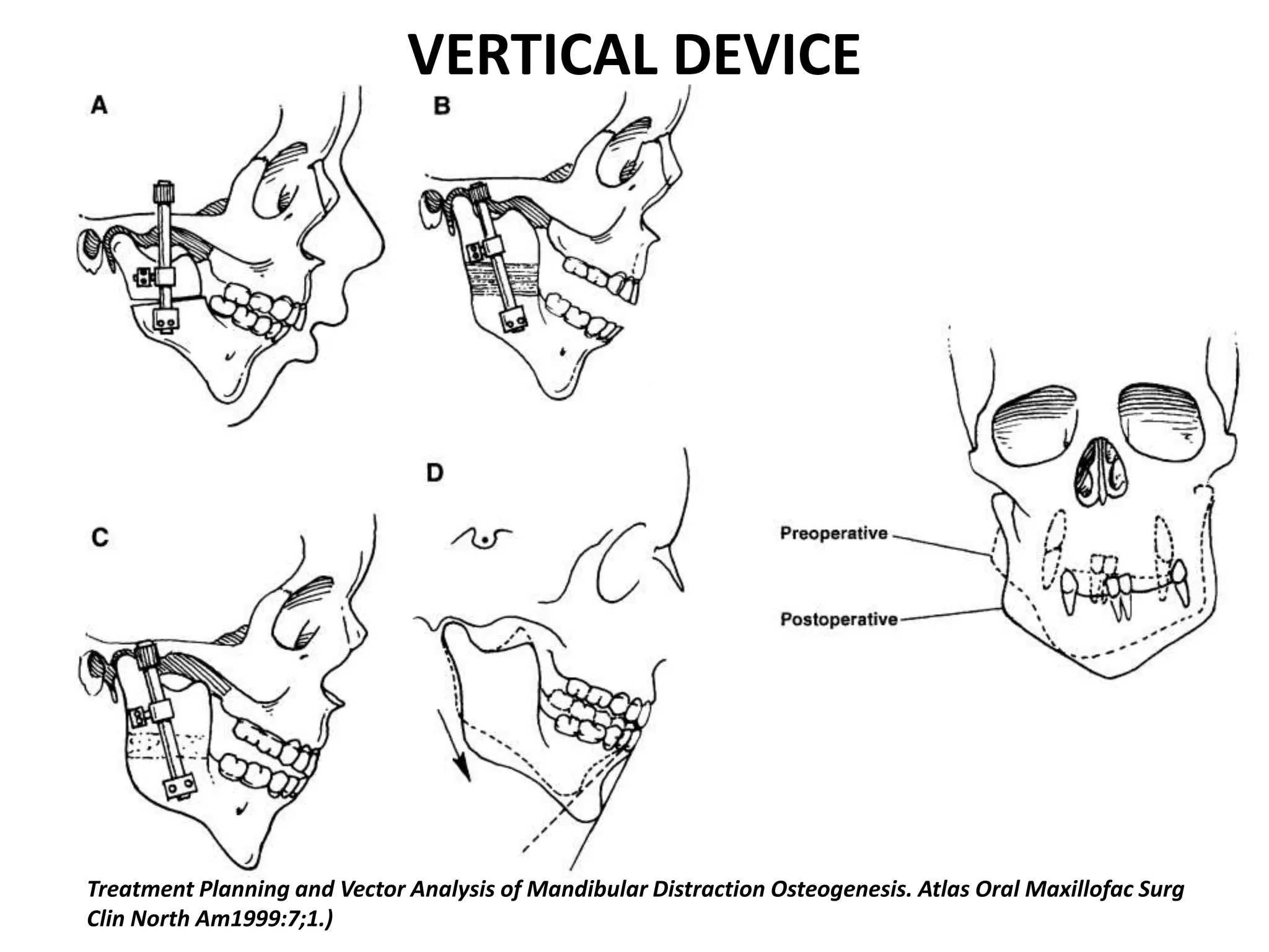BIOMECHANICAL CONSIDERATIONS IN DISTRACTION OSTEOGENESIS.pptx