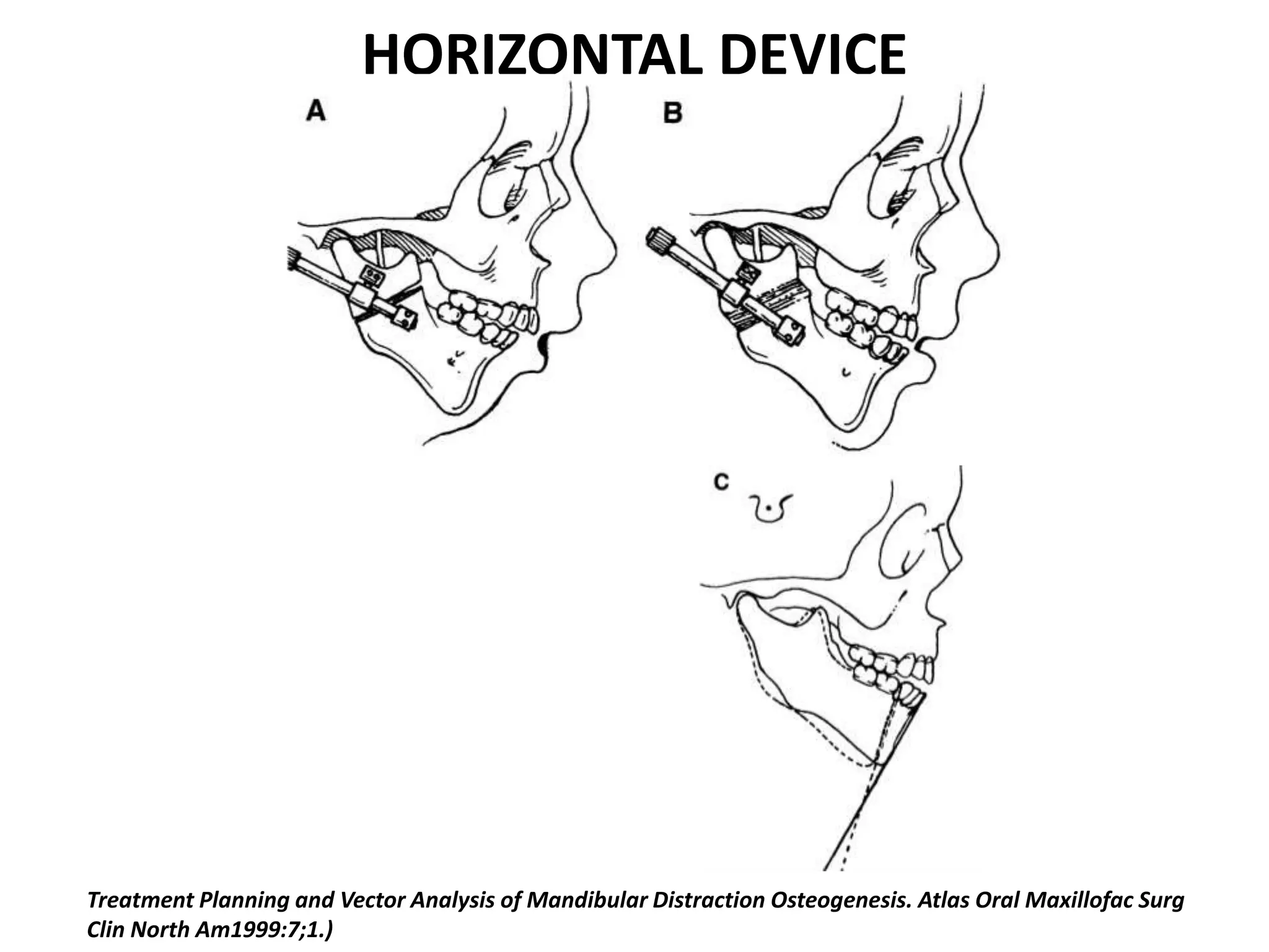 BIOMECHANICAL CONSIDERATIONS IN DISTRACTION OSTEOGENESIS.pptx