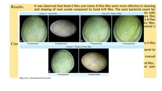Biomechanical preparation in primary teeth – Instrumentation and ...
