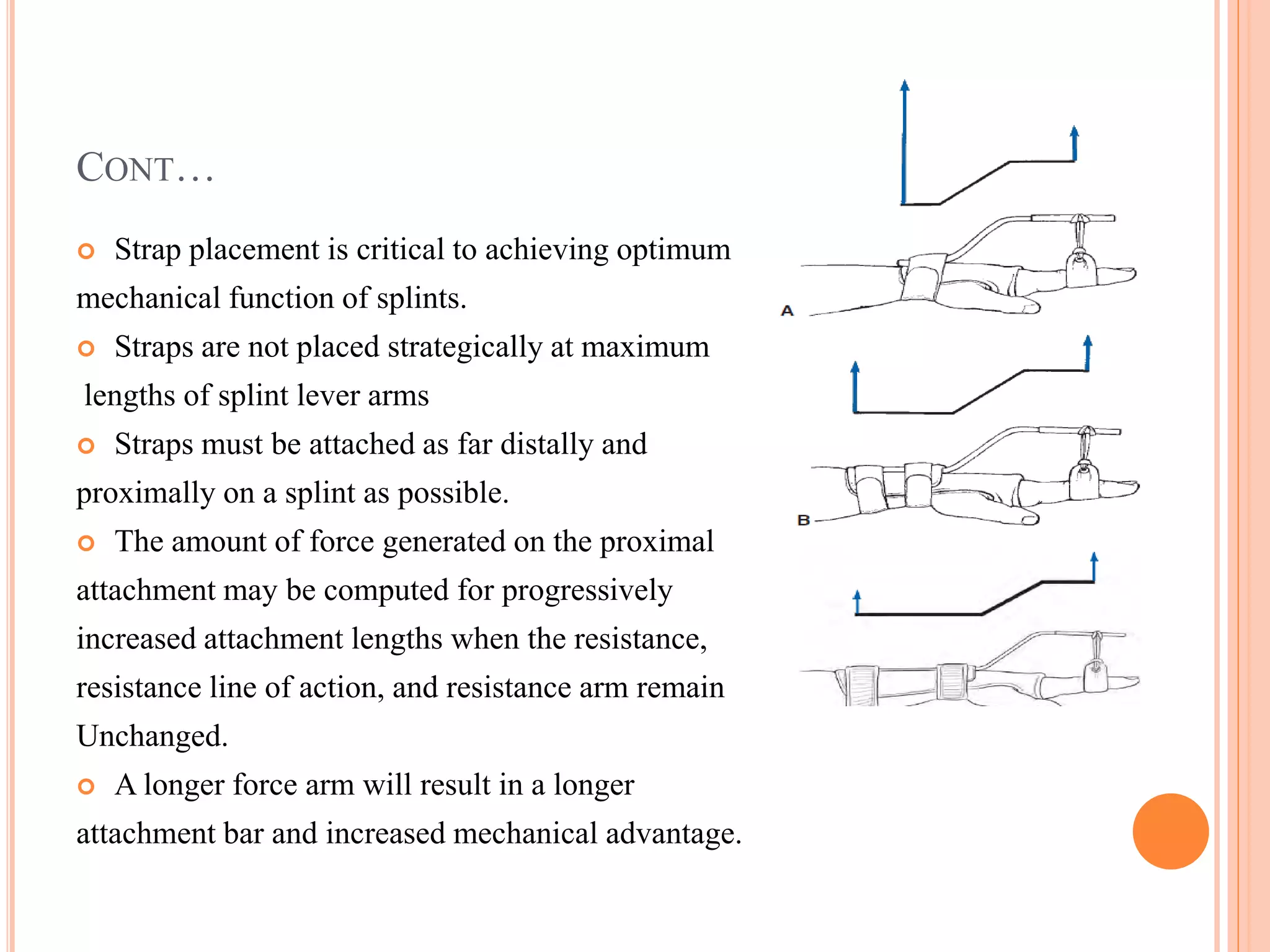 Biomechanical principle of hand splining | PDF