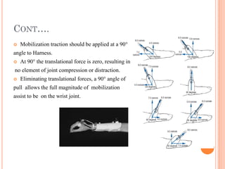 Biomechanical principle of hand splining | PDF