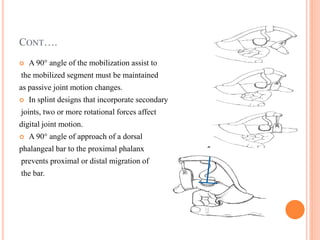 Biomechanical principle of hand splining | PDF