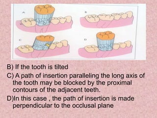 Biomechanical principles of TOOTH PREPARATION | PPTX