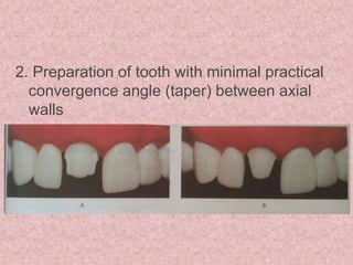 Biomechanical principles of TOOTH PREPARATION | PPTX