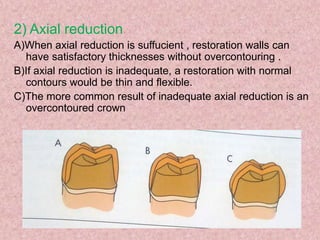 Biomechanical principles of TOOTH PREPARATION | PPT