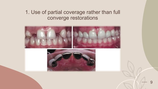 BIOMECHANICAL PRINCIPLES OF TOOTH PREPARATION.pptx | Dental Health | Diseases and Conditions