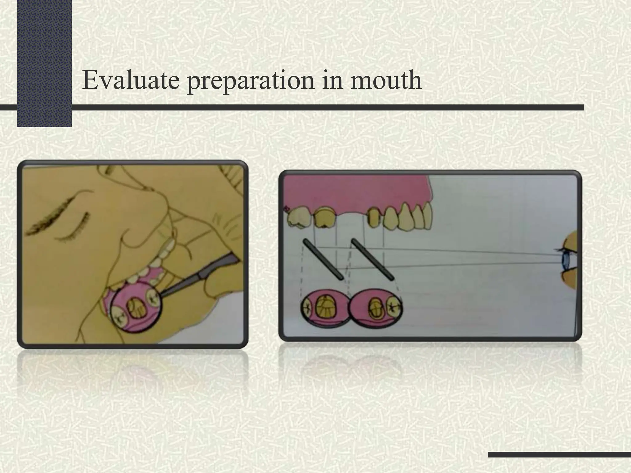 Biomechanical Principles of Tooth Preparation in FPD.ppt
