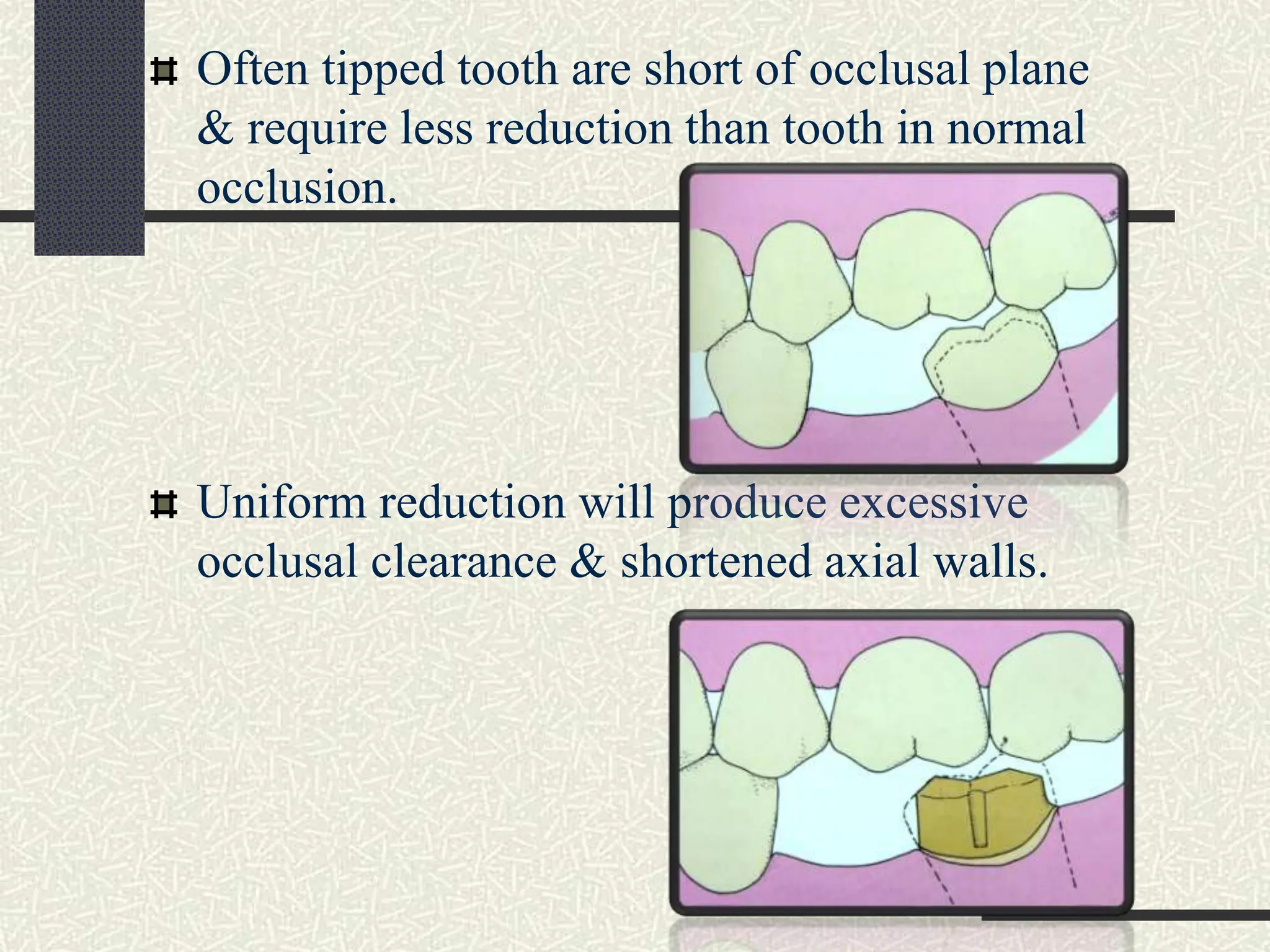 Biomechanical Principles of Tooth Preparation in FPD.ppt