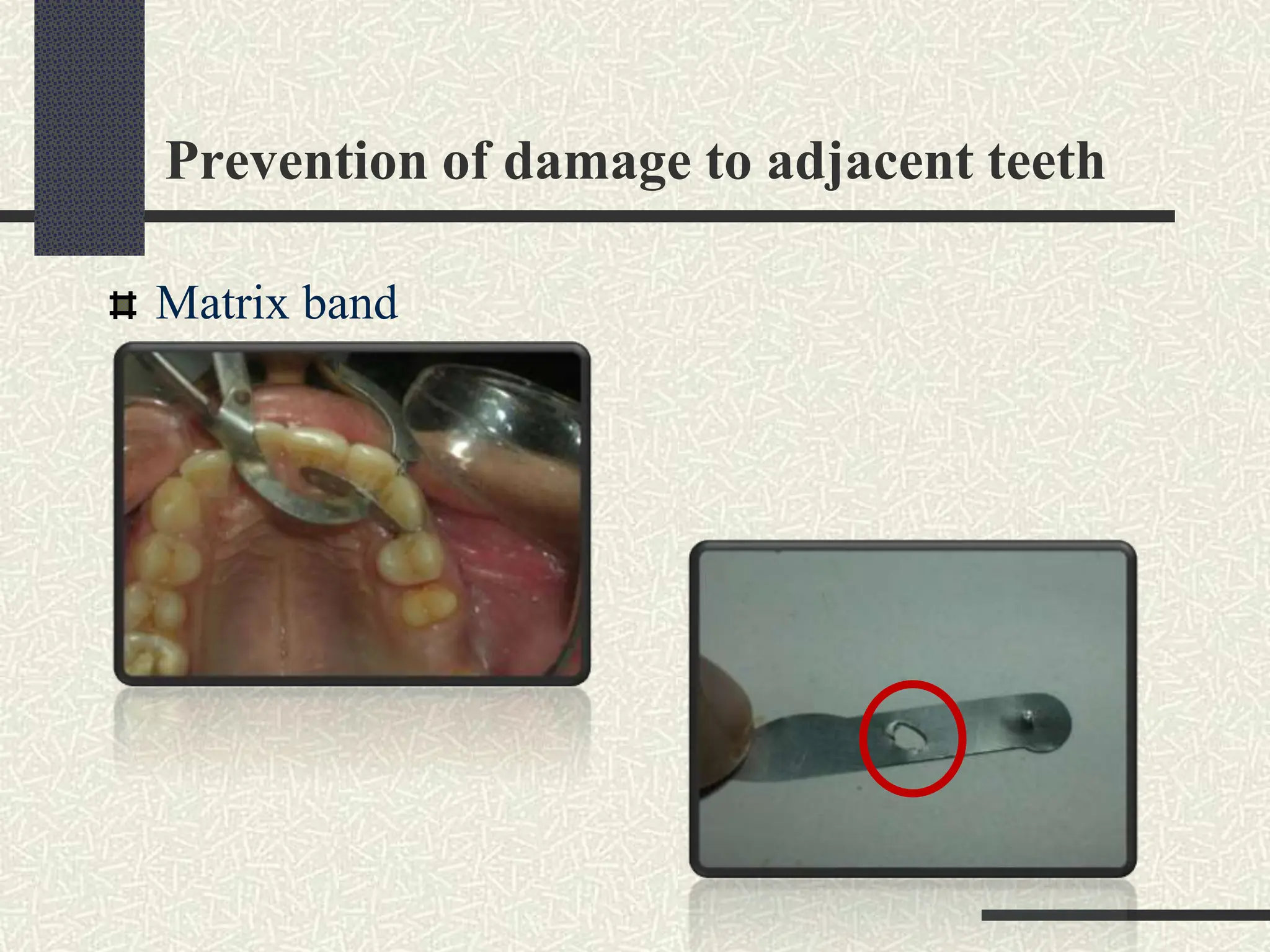 Biomechanical Principles of Tooth Preparation in FPD.ppt
