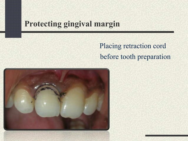 Biomechanical Principles of Tooth Preparation in FPD.ppt