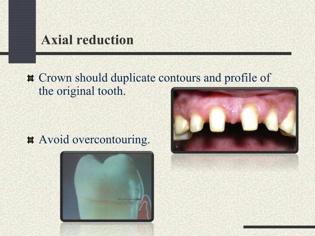 Biomechanical Principles of Tooth Preparation in FPD.ppt