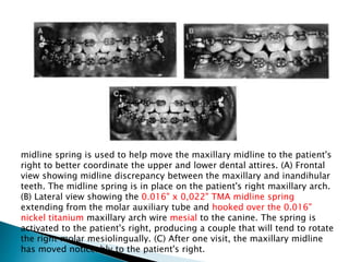 Orthodontic Biomechanics | PPTX