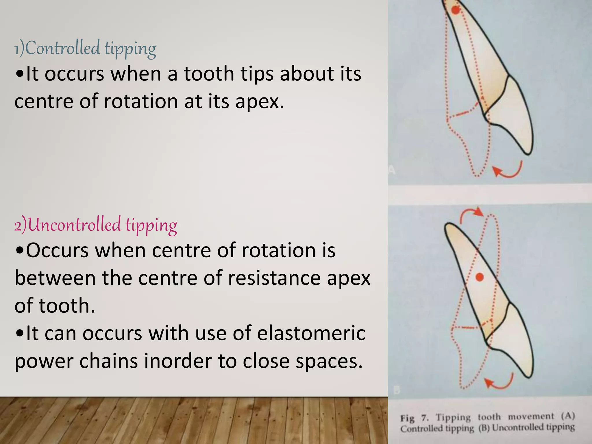 Biomechanics in Orthodontic tooth movements | PPTX