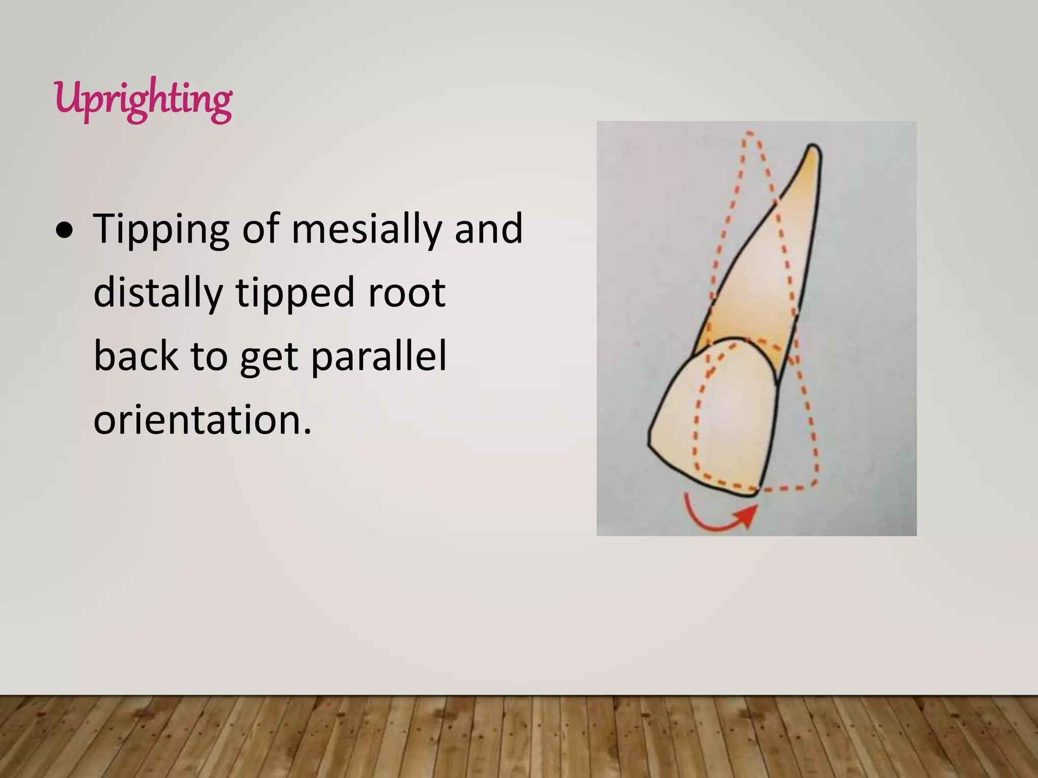 Biomechanics in Orthodontic tooth movements | PPTX