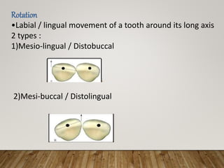 Biomechanics in Orthodontic tooth movements | PPTX