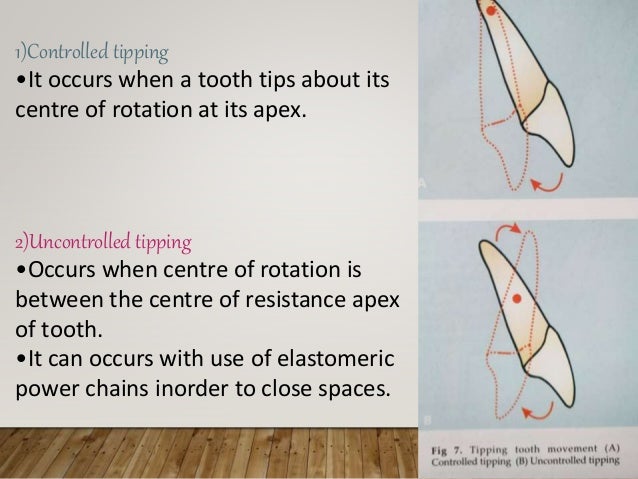 Biomechanics in Orthodontic tooth movements